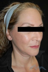 Dr. Max Polo's Facelift Patients - Miami Plastic Surgery