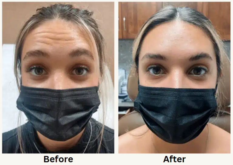 Miami Botox Injections | Miami Plastic Surgery